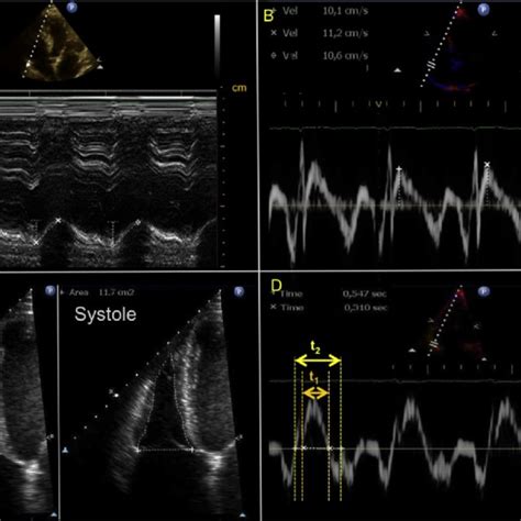 reproducibility of echocardiographic parameters to assess rv systolic