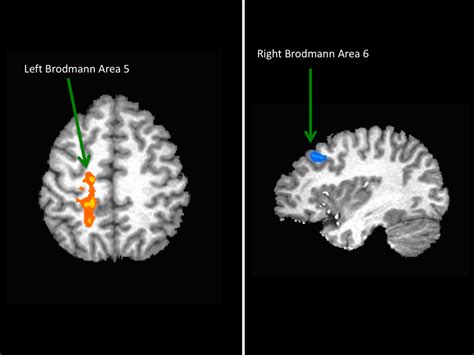 Brain Activity During Dual Tasking Regions Of Activation Included