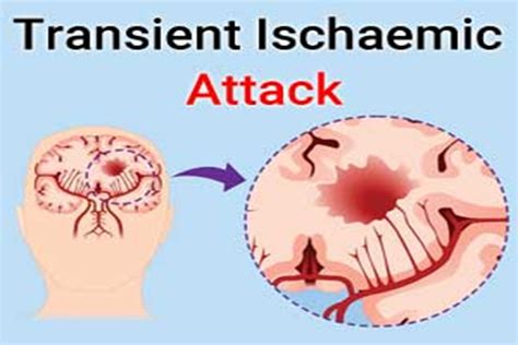 Treatment Of Transient Ischaemic Attack Tia Through Ayurveda