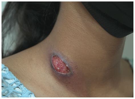 Scrofuloderma In A 27 Year Old Woman Cmaj