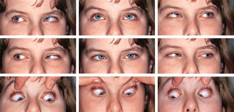 “a ” “v ” And Other Pattern Strabismus Clinical Tree