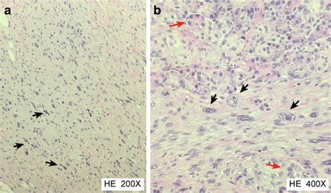Discernibly Atypical Sarcoma Cells Black Arrows Some Of Which Are Download Scientific
