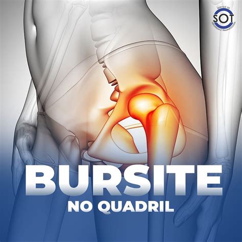 Sot Serviços De Ortopedia E Traumatologia Ss A Bursite No