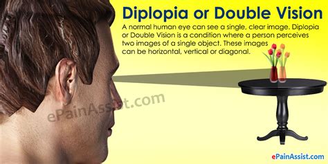 Diplopia Or Double Visioncausessymptomsteststreatment