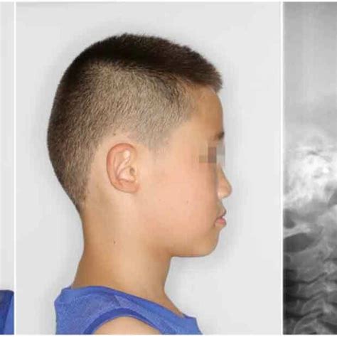 Skeletal Class Iii Malocclusion Patient Before Treatment Download Scientific Diagram