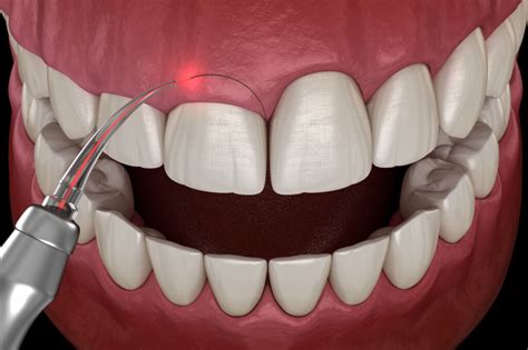 Laser Dentistry Rodney Street Dental