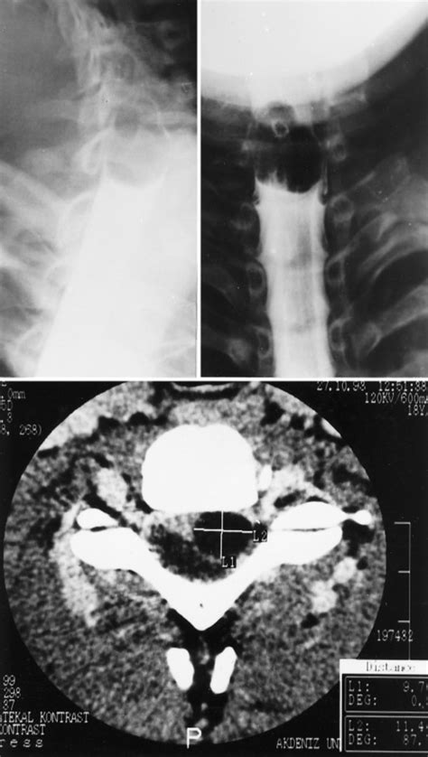 Subarachnoid Cyst Spinal Meningitis