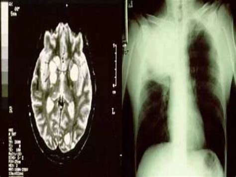 Yeasts Of Medical Importance Candida And Cryptococcus Ppt Yeasts Of Medical Importance Candida And Cryptococcus Ppt