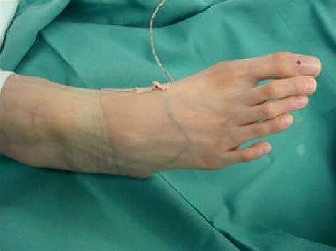 A B Arachnodactyly And Contractures Of The Proximal Interphalangeal