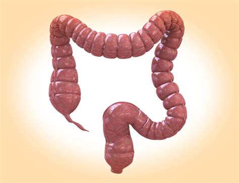 Icd 10 Coding Diverticulosis Aapc Knowledge Center