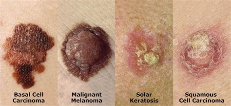 Malignant Skin Lesions