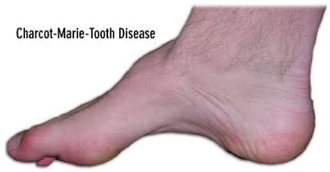 Nurses Notes Charcot Marie Tooth Disease Hereditary Disorder