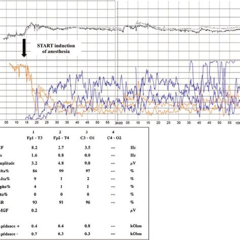 Data Recorded From Bilateral Cerebral Oximetry Monitor Processed