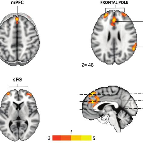 Significantly Stronger Bold Signals In Homosexual Vs Heterosexual
