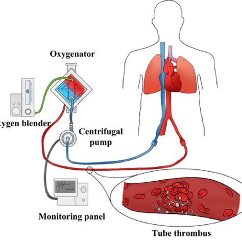 Extracorporeal Membrane Oxygenation Ecmo Is Composed Of Five Parts A