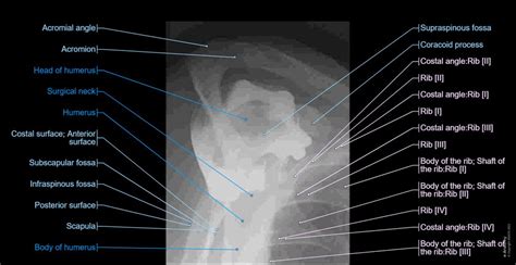 Ct Arthrogram Of The Shoulder Joint Normal Anatomy E Anatomy