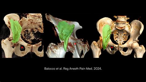 New Insights Into Peng Block 3d Ct Scan Study On Injectate Spread Nysora New Insights Into Peng Block 3d Ct Scan Study On Injectate Spread Nysora