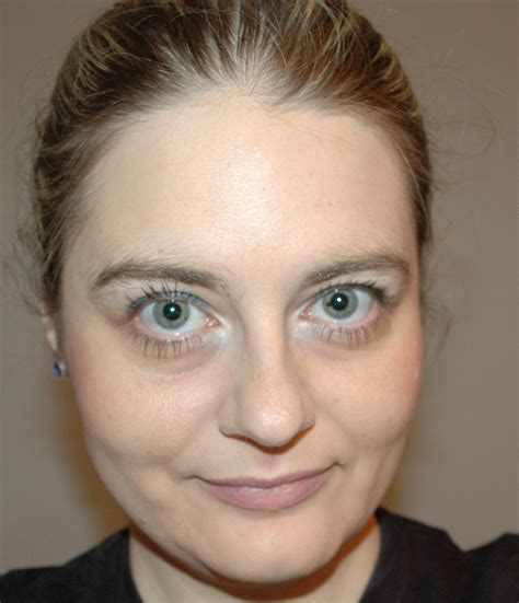 Ehlers Danlos Syndrome 6 Spells Multiple Problems For Dagmara Global