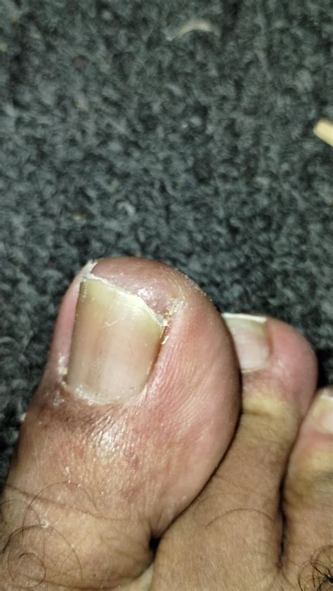 Is This An Ingrown Toenail Issue R Ingrown Toenails