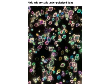 Urinary Lithiasis Etiology Pathogenesis Types Of Urinary Lithiasis Pptx
