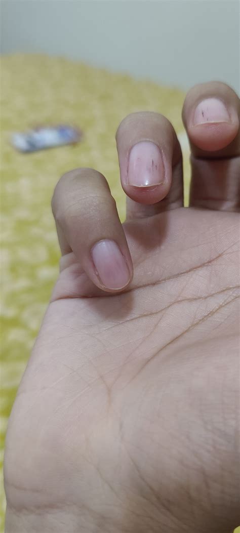 Ask A Dermatologist Online For Splinter Hemorrhage