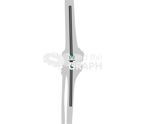 Free Exfix Abx Spacer Anteroposterior Bone Icons Symbols Pictures