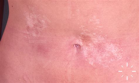 Dermacompass Morphea