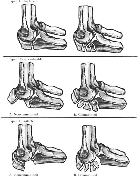 Olecranon Fractures Musculoskeletal Key