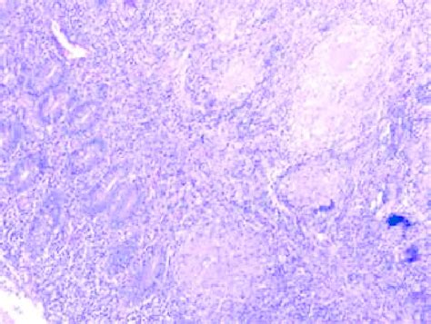 Microphotograph Showing Mucosa Of Appendix Infiltrating With Download Scientific Diagram