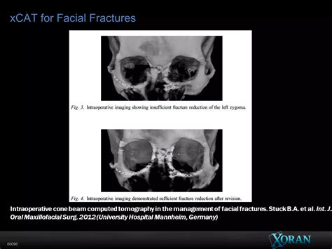 Xorans Xcat High Resolution Low Dose Head Ct Pdf