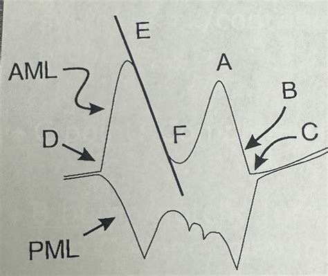 Mitral Valve M Mode Flashcards Quizlet Mitral Valve M Mode Flashcards Quizlet