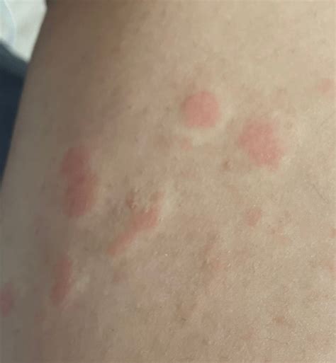 빈대 진드기 물린 자국 지식in