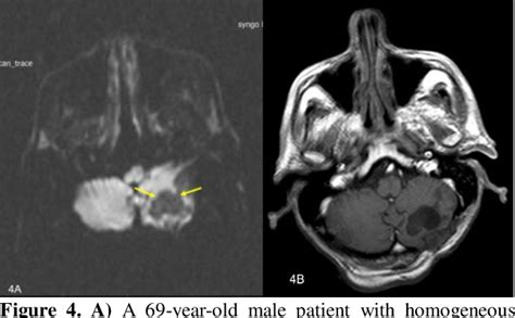 Figure 1 From Comparison Of Diffusion MRI Findings Of High Graded Primary Brain Tumors And