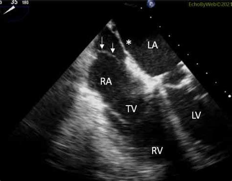 Te Eustachian Valve Echo By Web