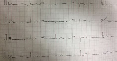 Cardiology Window Severe Sinus Node Dysfunction With Junctional Bradycardia