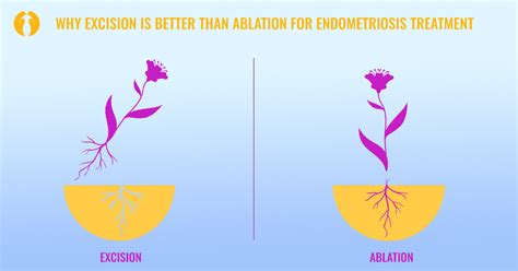 Why Excision Is Better Than Ablation For Endometriosis Treatment The Center For Innovative Gyn
