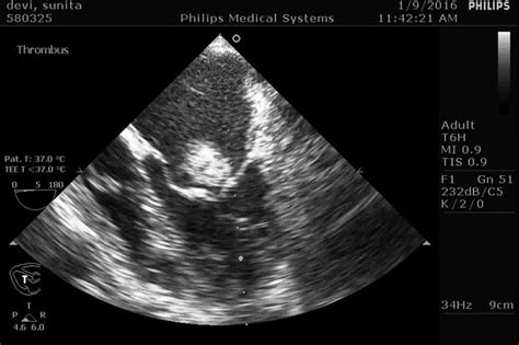 Left Atrial Thrombus Present Is That About It Journal Of Cardiac Critical Care Tss