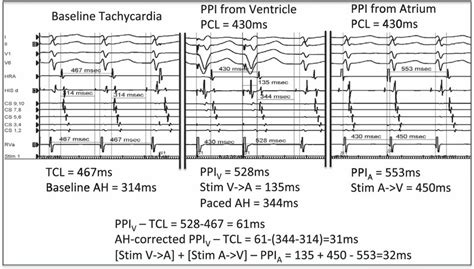 Example Of Using Time Intervals Obtained During Atrial And Ventricular Download Scientific