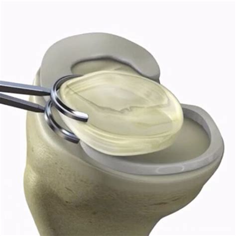 Implant Procedure Archives Nusurface