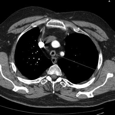 Ct Scan Of Patient No 1 Just Below Carina With Thickening Of The Airway
