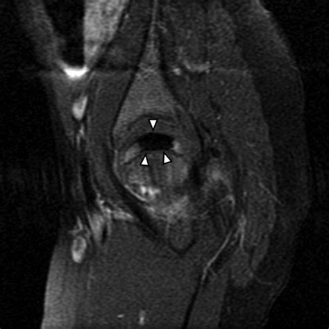 Mri Of Legg Calvé Perthes Disease Ajr