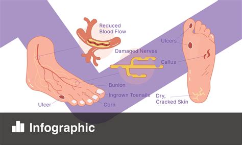 Diabetic Peripheral Neuropathy Vs Diabetic Neuropathy At Antonio Fore Blog