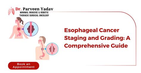 Navigating Esophageal Cancer Tnm Staging Grading And Treatment Insights