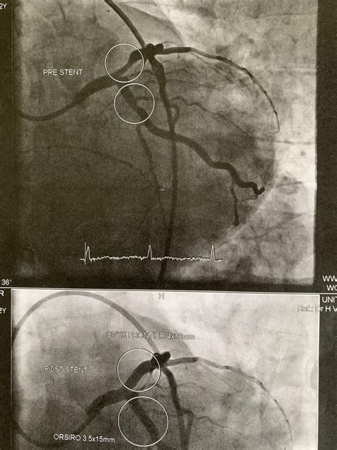 10 Months Post Stemi Rheartattack