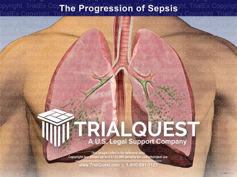 The Progression Of Sepsis Trialexhibits Inc