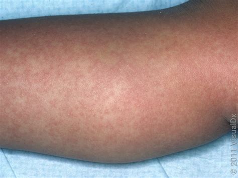 Erythema Infectiosum Fifth Disease 39slapped Cheeks Racgp Clinical