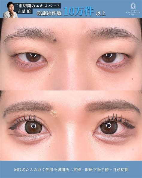 4方向リフト 」に関する美容整形の症例写真の詳細 東京シンデレラ美容外科 新宿池袋大宮
