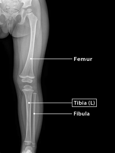 Tibia Shin Bone Definition Location Anatomy Diagrams