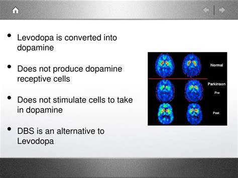 Ppt Dbs On Parkinsons Disease Powerpoint Presentation Id5664169