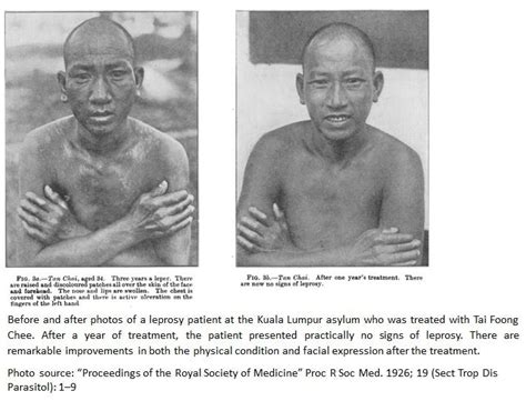 Leprosy Before And After Treatment